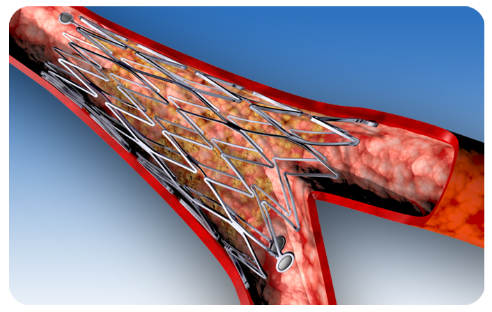 Cardiovascular | Biosensors International Ltd